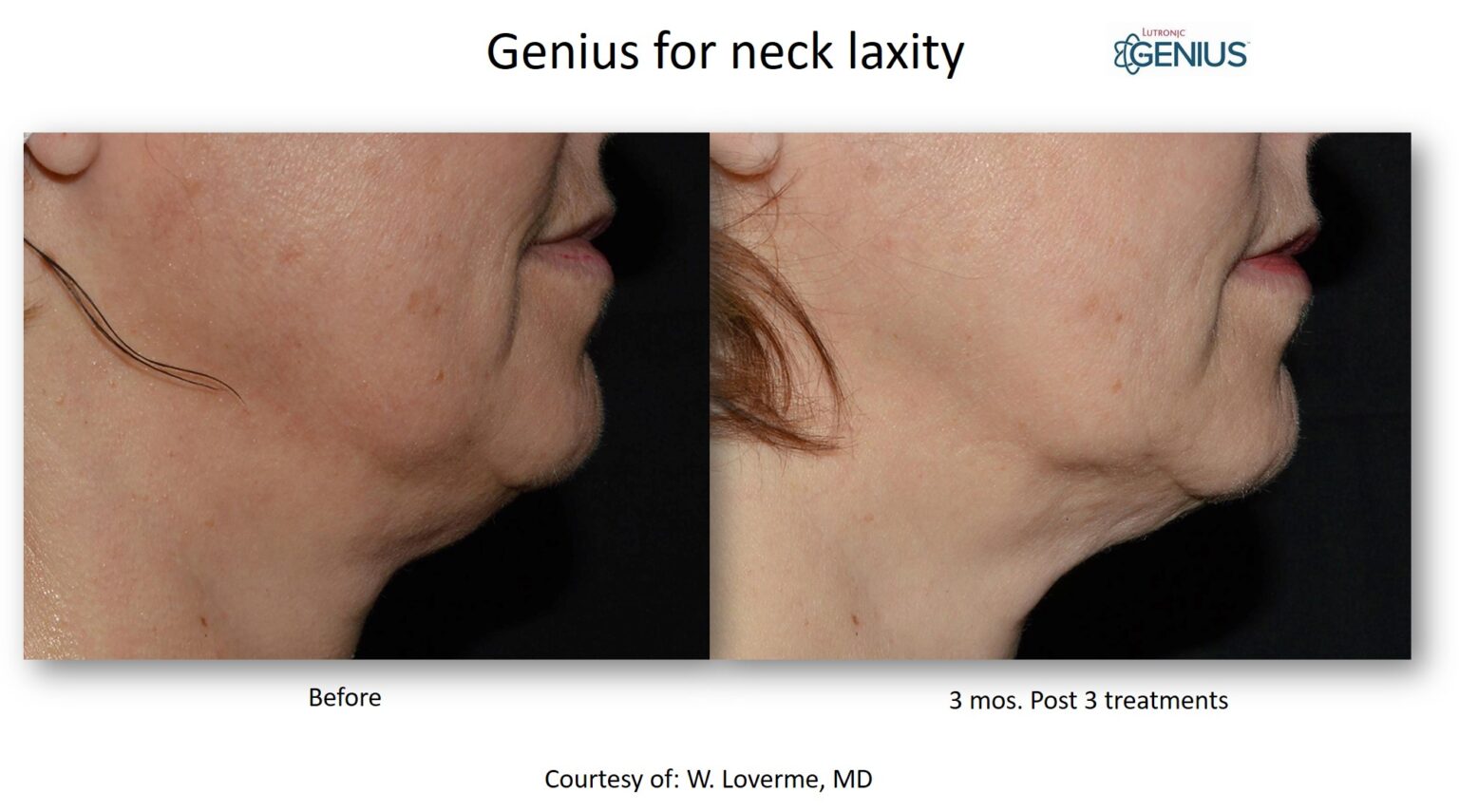 GENIUS RF Microneedling Lexington KY – Wells Plastic Surgery